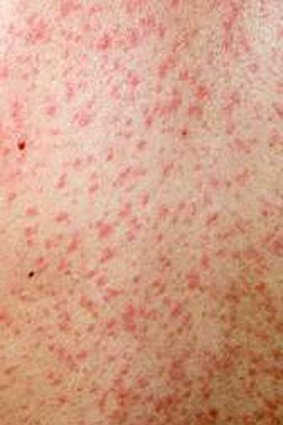 WA measles outbreak linked to Bali WA measles outbreak linked to Bali