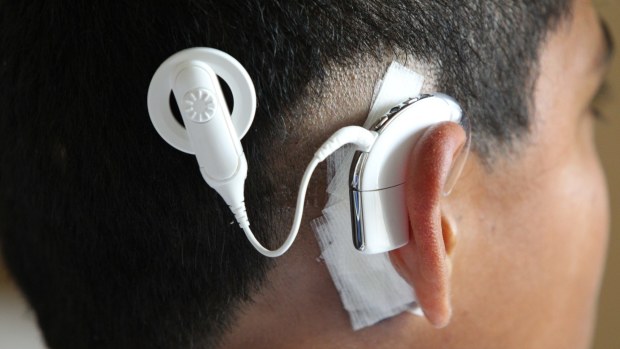 Cochlear locked in Chinese discounting war
