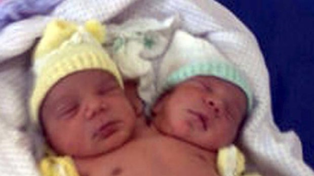 Twins born with one body and two heads