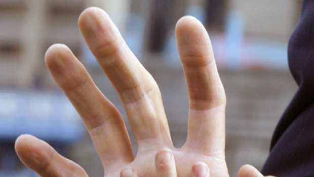 Finger length predicts prostate cancer risk: study