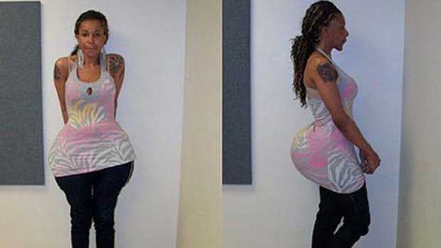 More women allege botched buttocks surgery with cement concoction