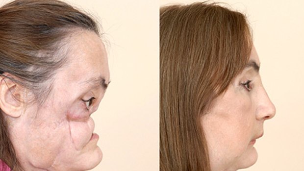 Transplant woman shows off her new face