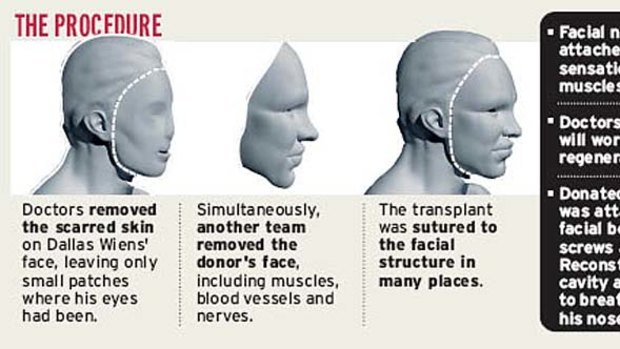 US patient thanks donor's family for full-face transplant