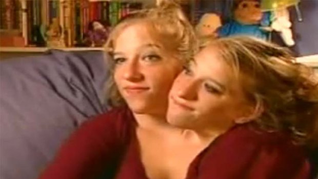 Two heads, one body: what can be done for tragic twins?