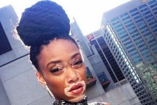 Model with rare skin disease lets her quirks shine