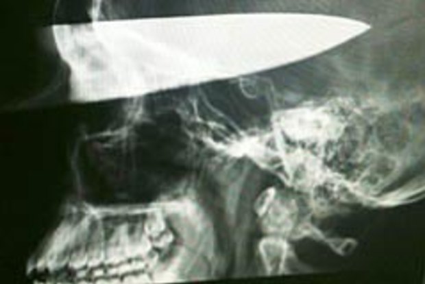 Alive despite a knife buried in his face