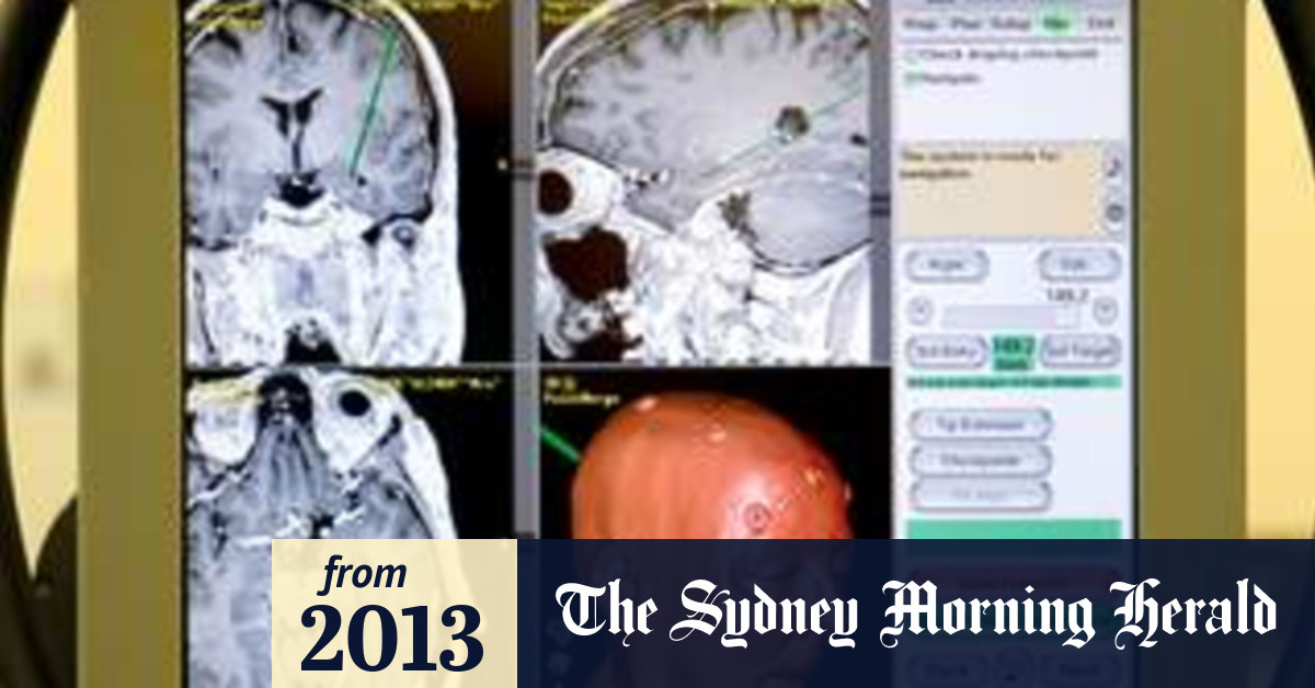 St. Vincents' Stealth Surgery