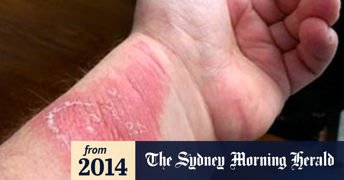 Fitbit Force causing rashes, sores in some users