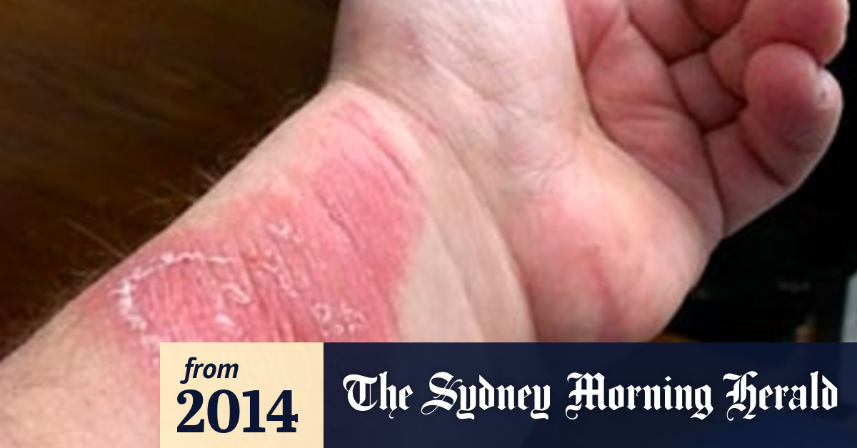 Fitbit Force causing rashes, sores in some users