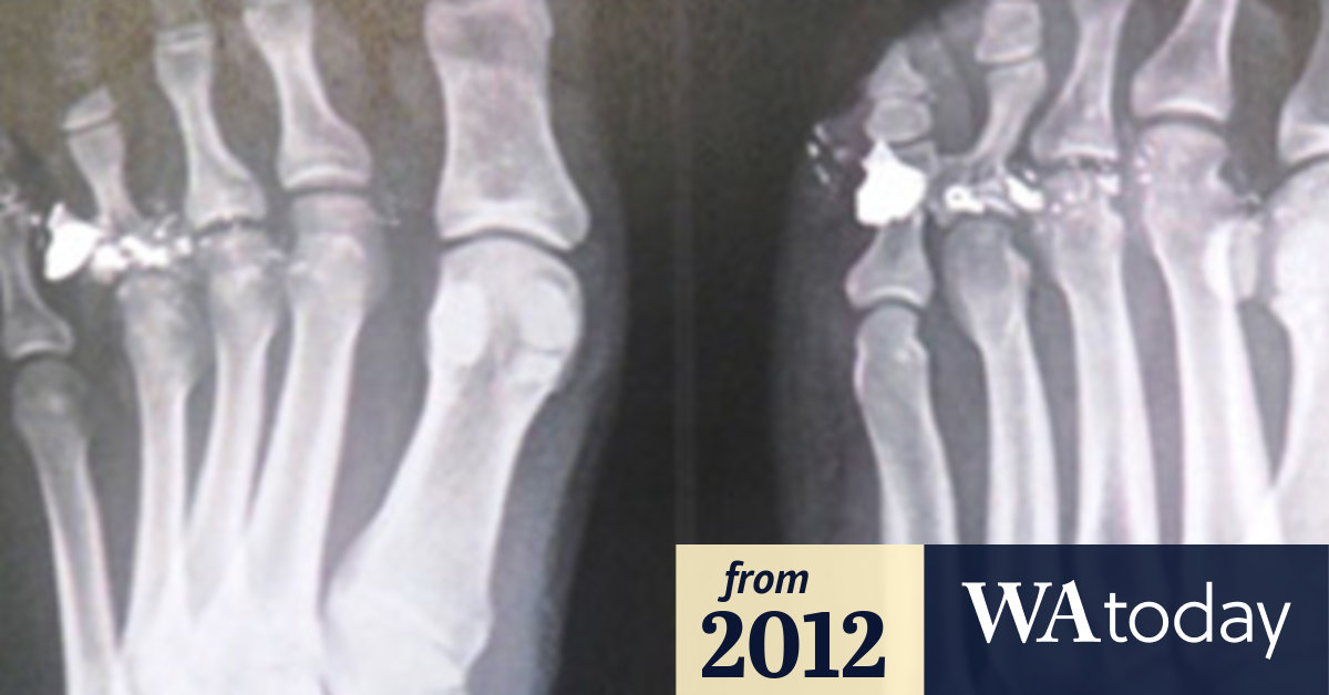 Man shot in foot with spear gun