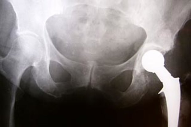 Patients forced into repeat surgery over faulty hip implants