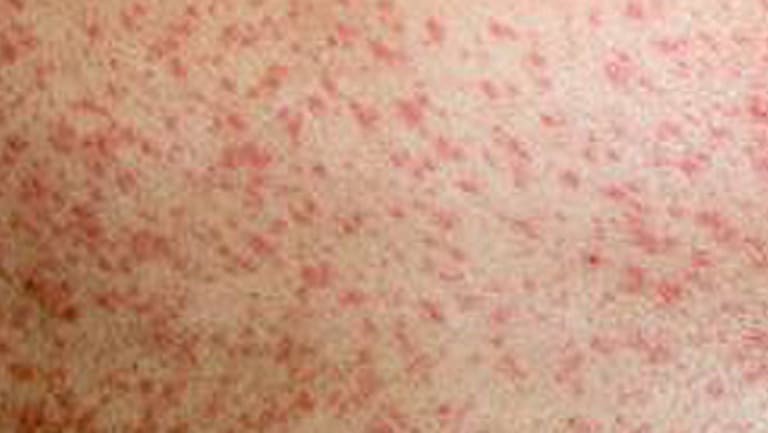 Measles alert issued for Melbourne Airport due to infected passenger