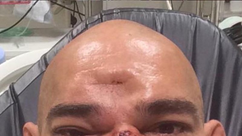 Evangelista 'Cyborg' Santos fractures skull in brutal MMA fight