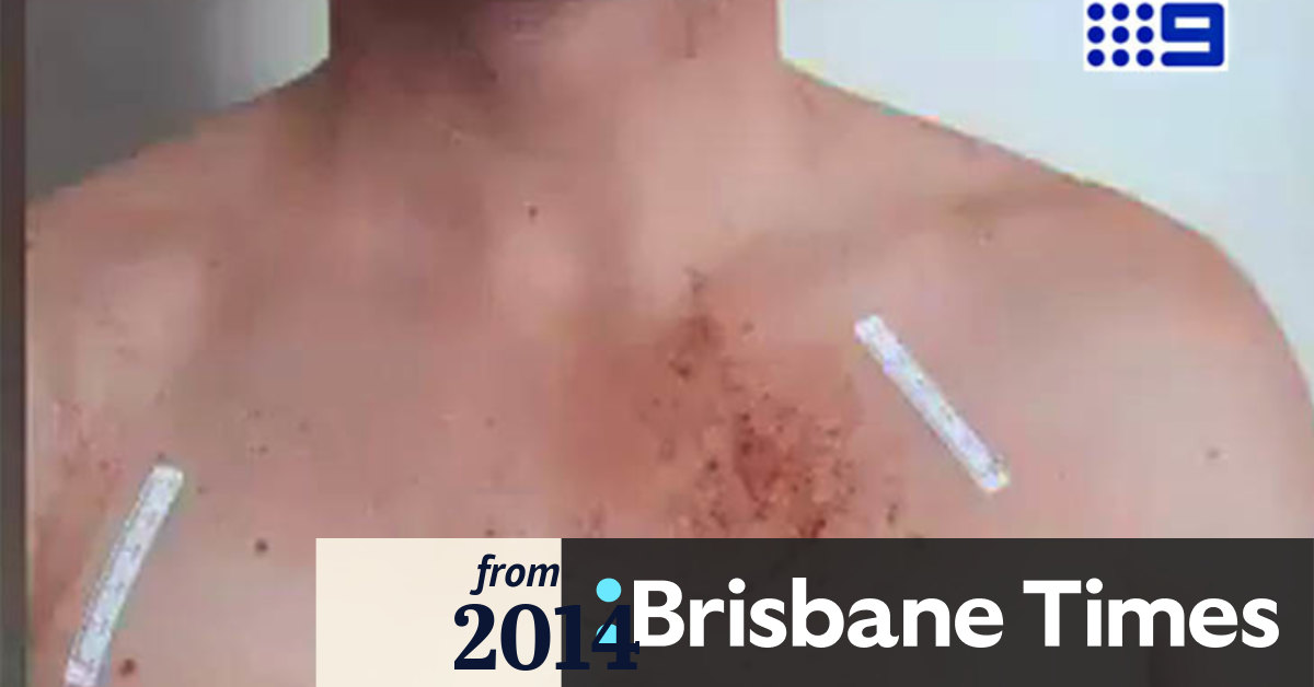 Video: Marks likely to be fingernail scratches