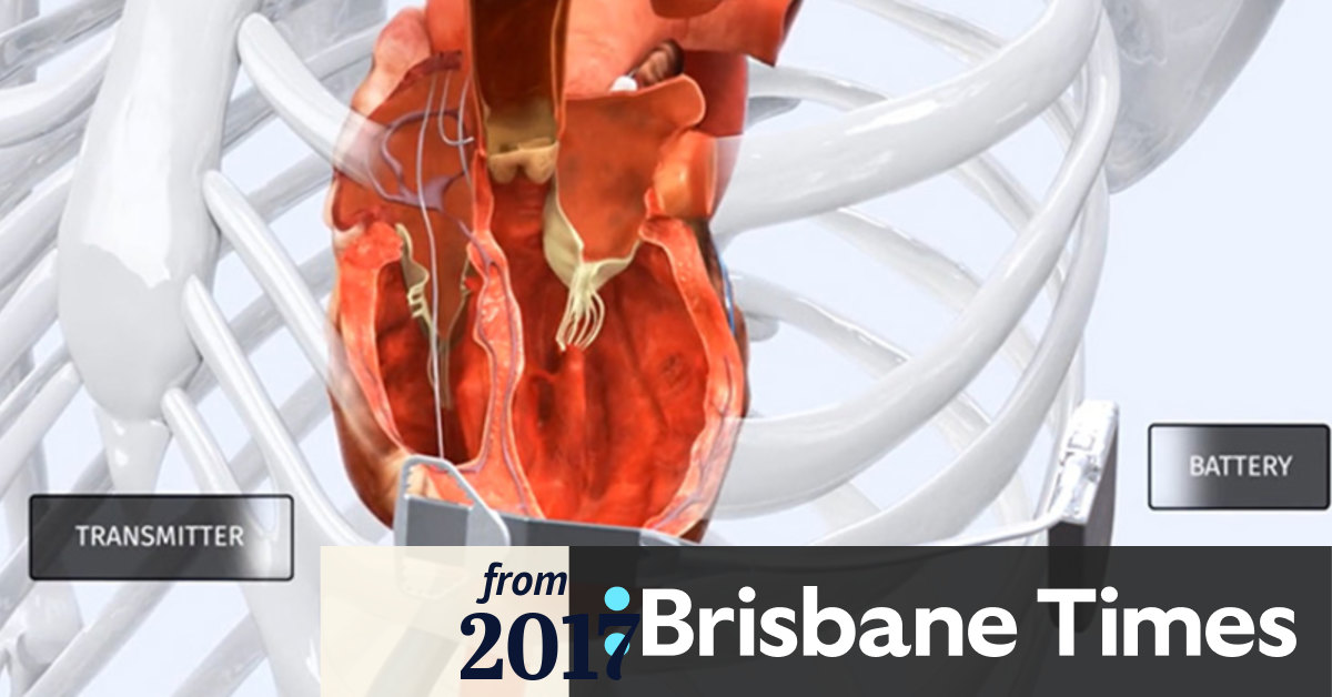 Video: How the WiSE-CRT wireless pacemaker works