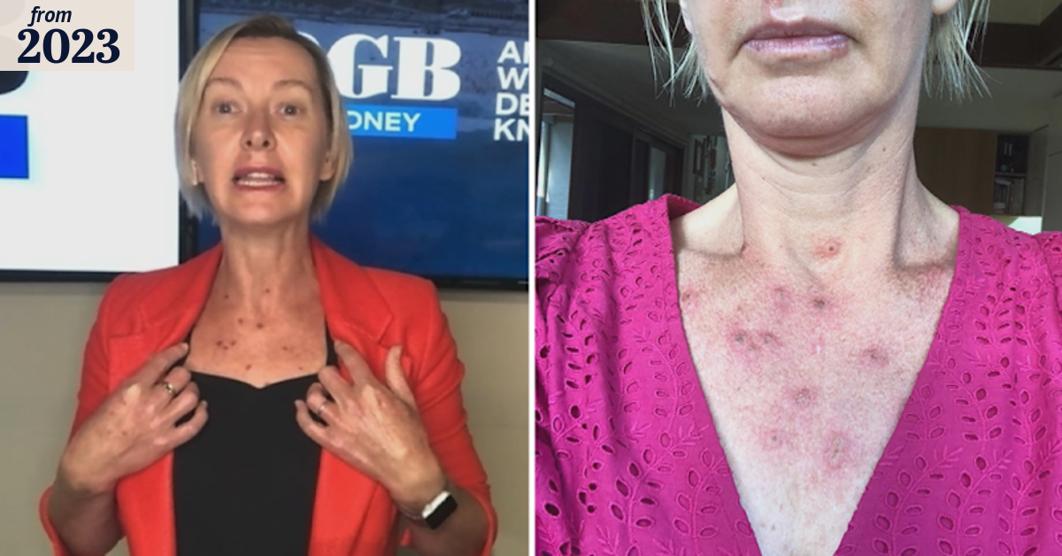 Video: Deborah Knight warns of sunbaking dangers