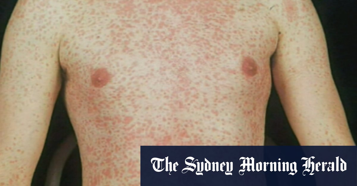 Video: Measles case prompts health alert in SA and Victoria