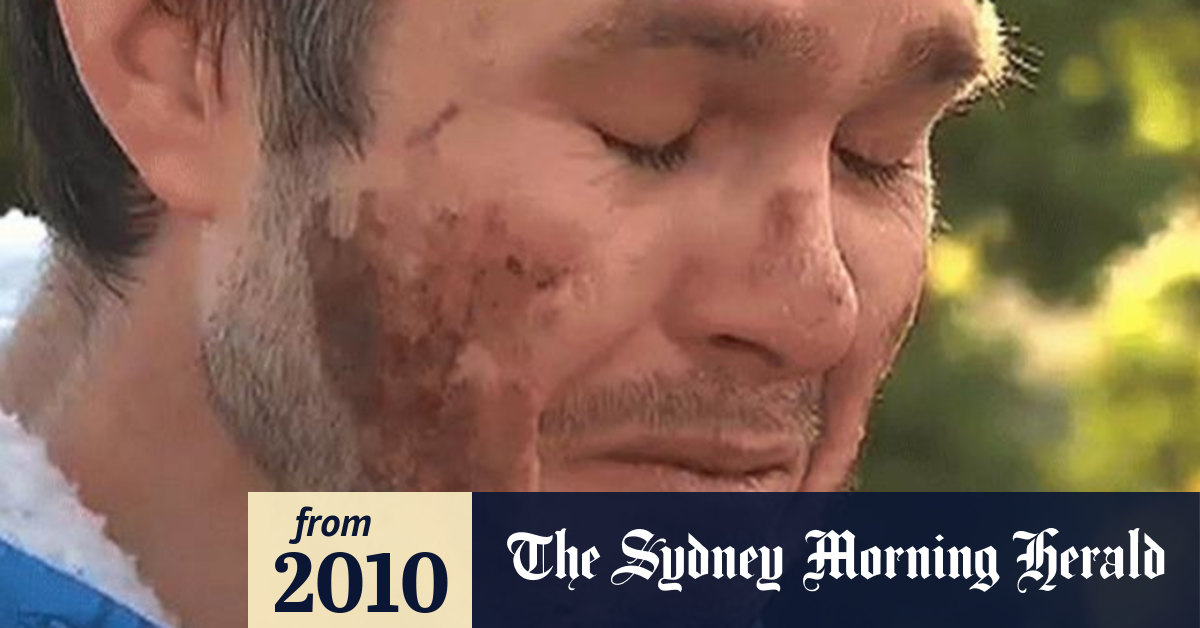 Video: Acid attackers burn man's face