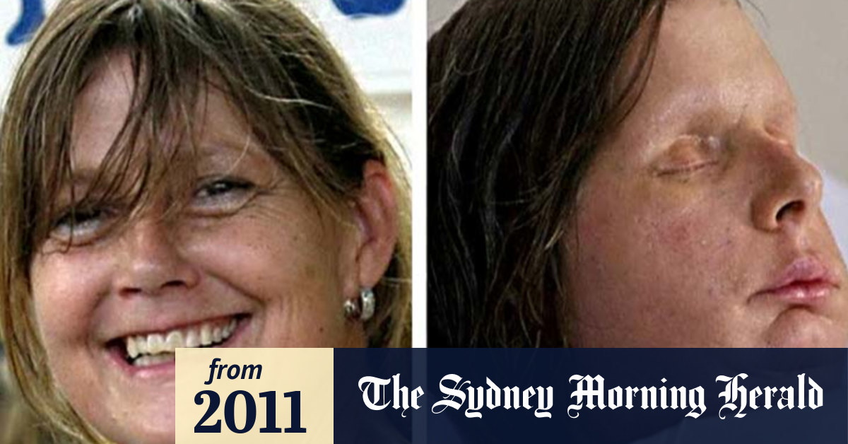 Video: Chimp attack victim shows new face