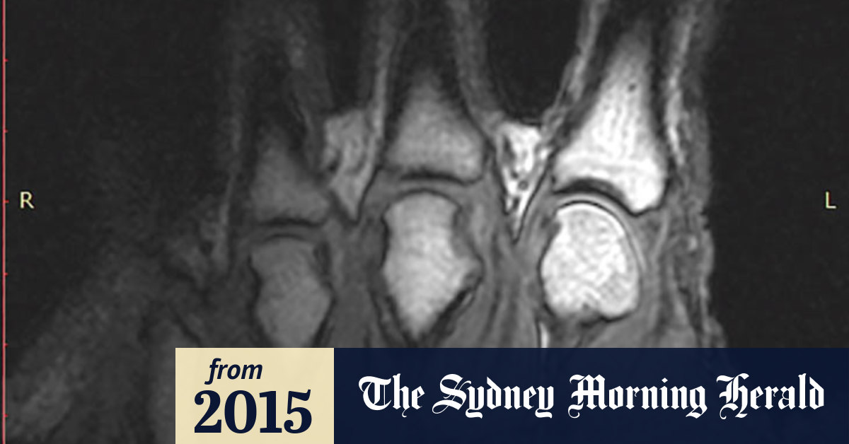 Video: What happens when you crack your knuckles