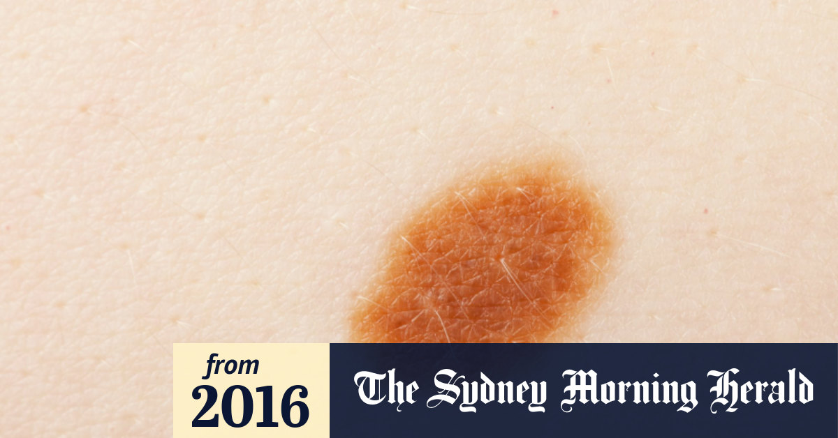 Common lumps and bumps on and under the skin: what are they?