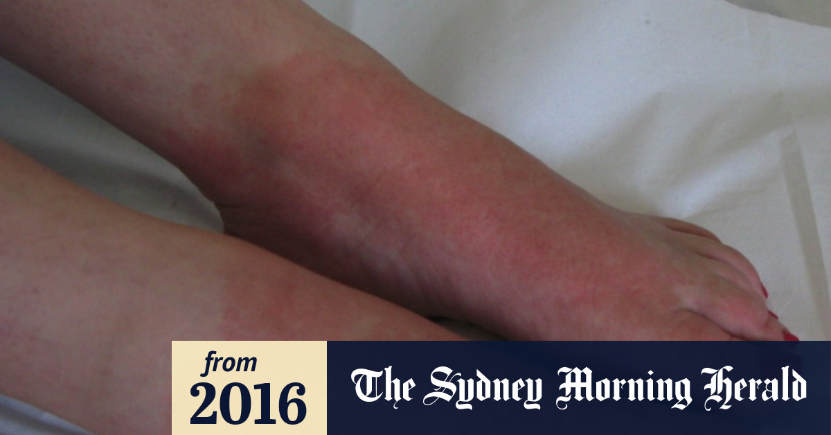 Protective compound added to skin cells helps body fight eczema ...