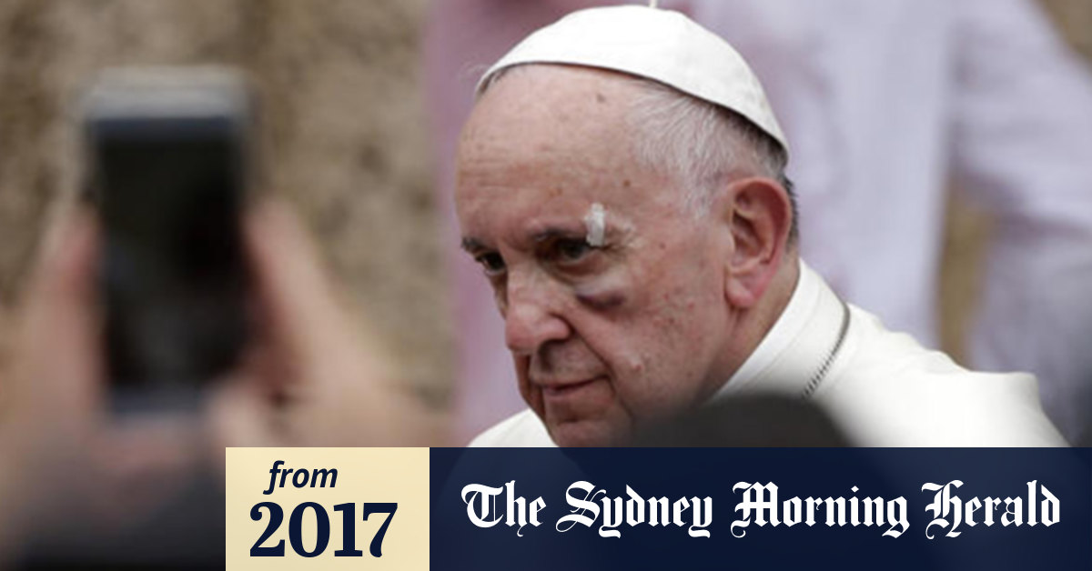 Video: Pope suffers bruises on his cheek and eyebrow