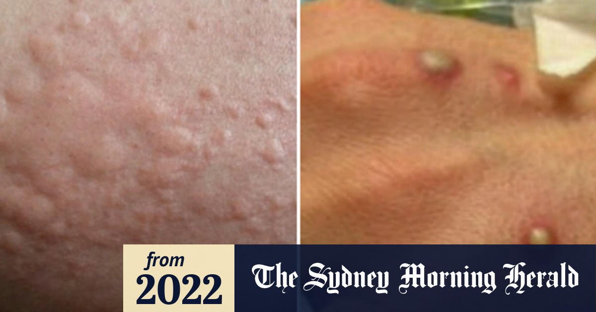 Video: New monkeypox case detected in Queensland