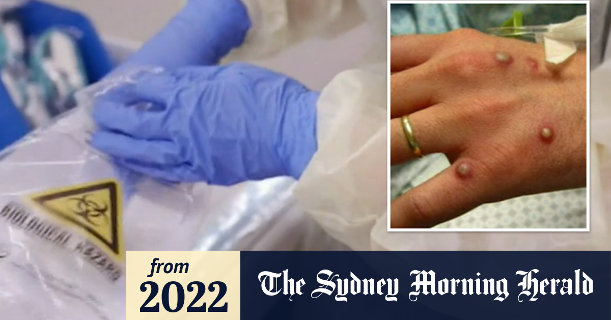 Video: Second monkeypox case recorded in Western Australia