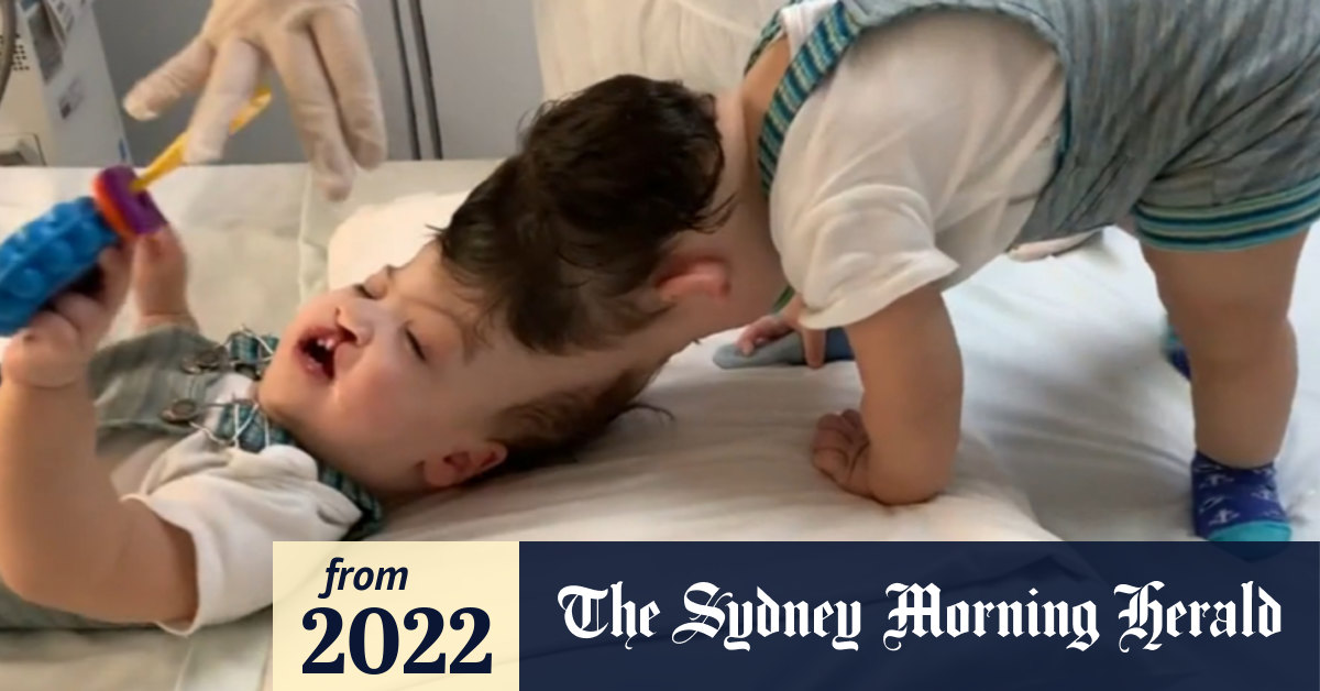 Video: Surgeons successfully separate twins with fused brain