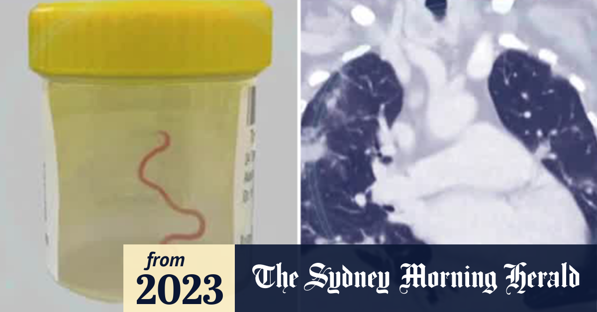 Video: Live worm found inside Australian woman's brain