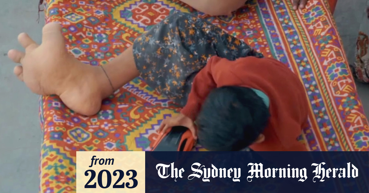 Video: Meet Vedant, a young boy whose right foot won't stop growing