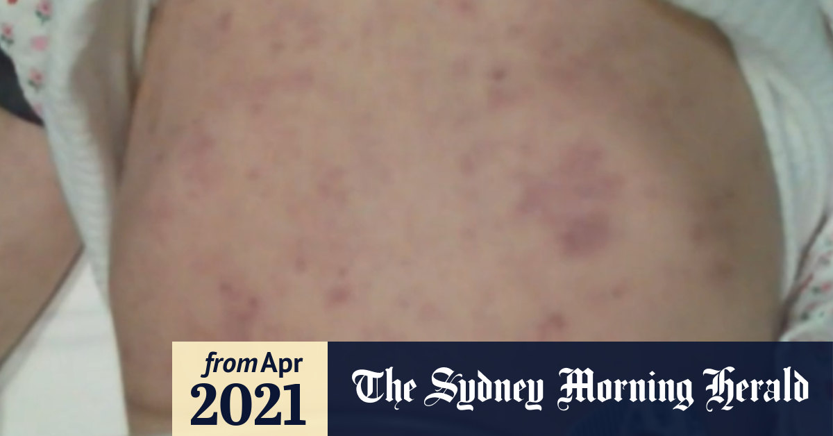 Video: Baby hospitalised with meningococcal