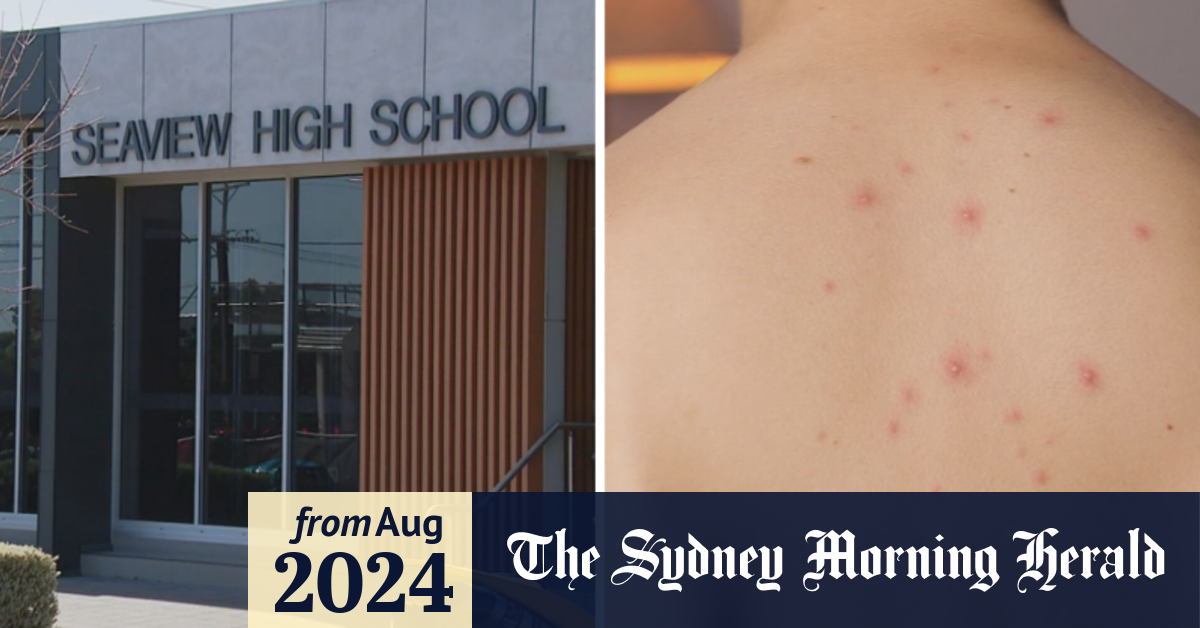 Video: Adelaide hit with chicken pox outbreak