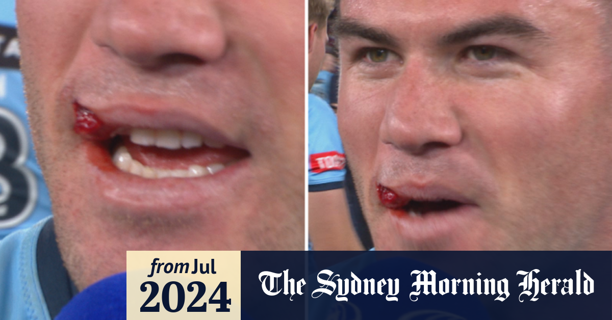 Video: Best 'definitely felt' lip injury