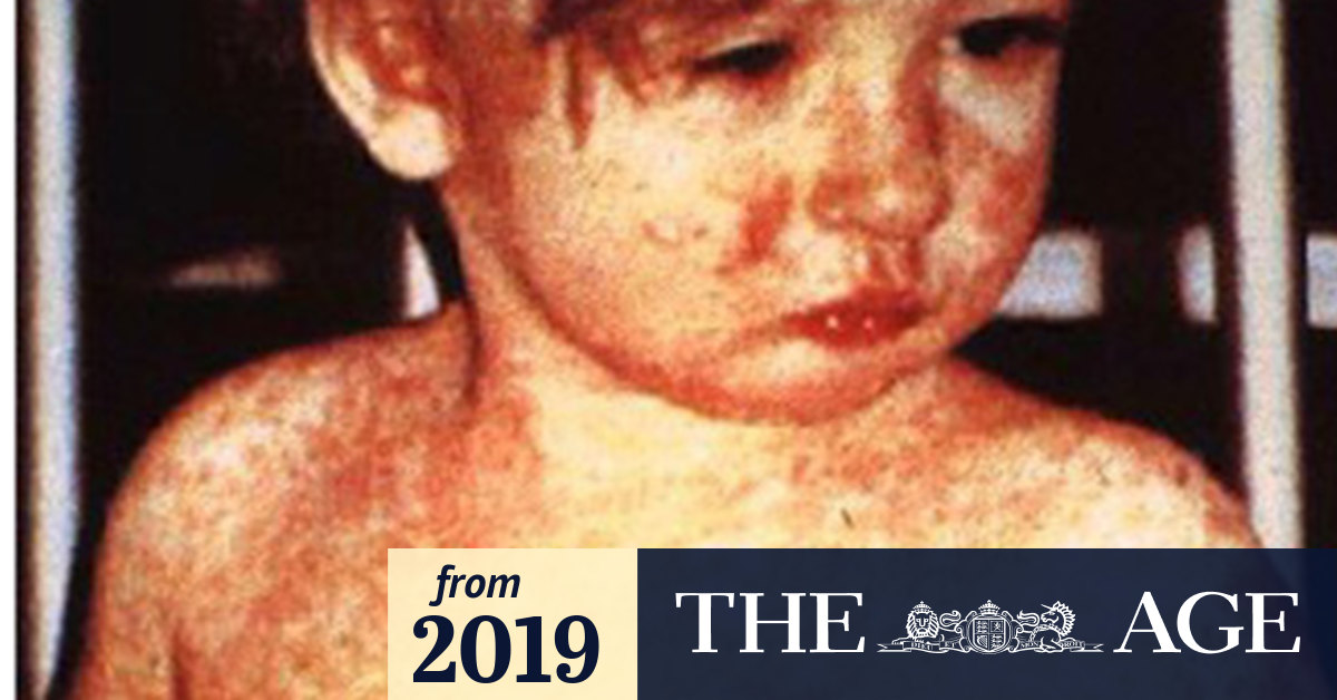 Video: A guide to measles in Australia