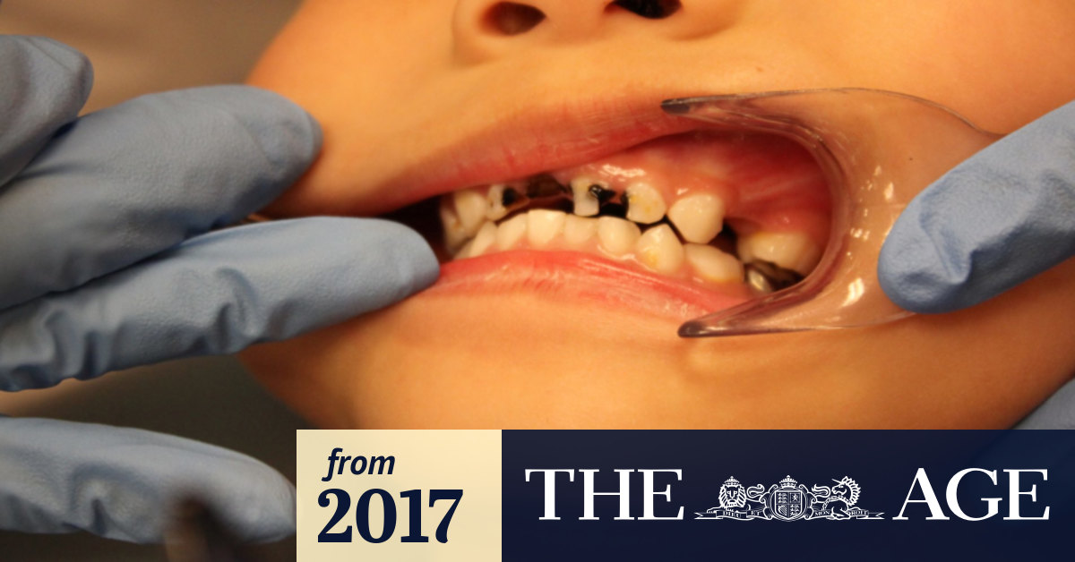 'Horrifying this still occurs': Extreme tooth decay lands thousands in ...