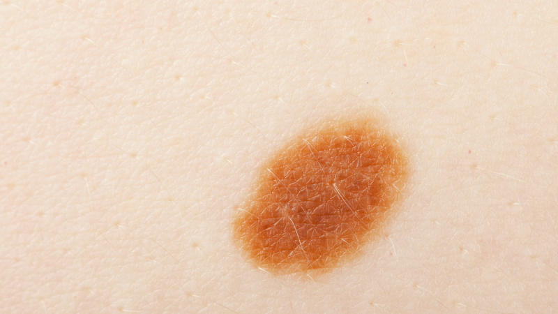 Common lumps and bumps on and under the skin: what are they?