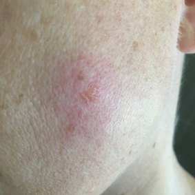 spider bite on face while sleeping