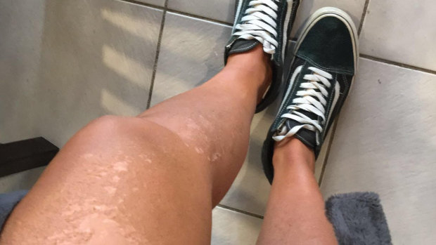 Extreme sunburn lands Victorians in hospital at increasing rates
