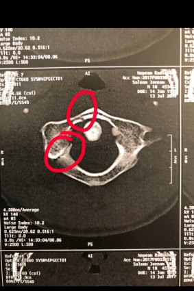 How Parramatta debutant cheated death with broken neck