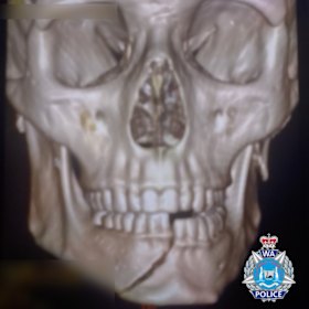 Cassius Turvey’s brother bailed after alleged skate park assault that ...