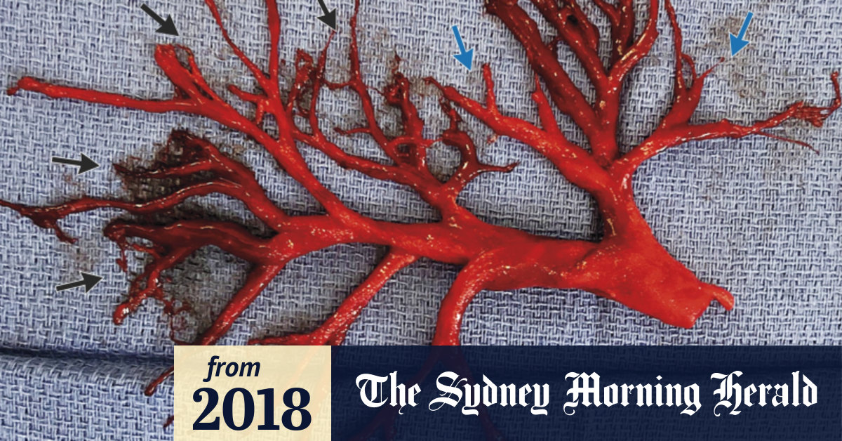 'We were astonished': Man coughs up huge mystery blood clot