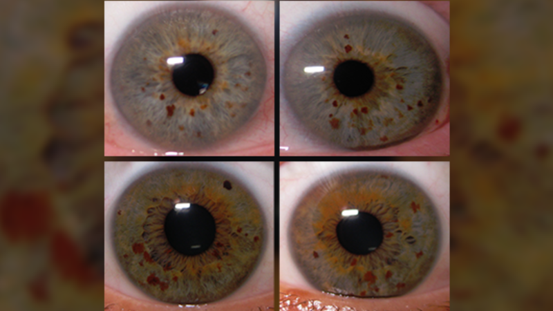 Spots on your eyes could be warning signs worth watching