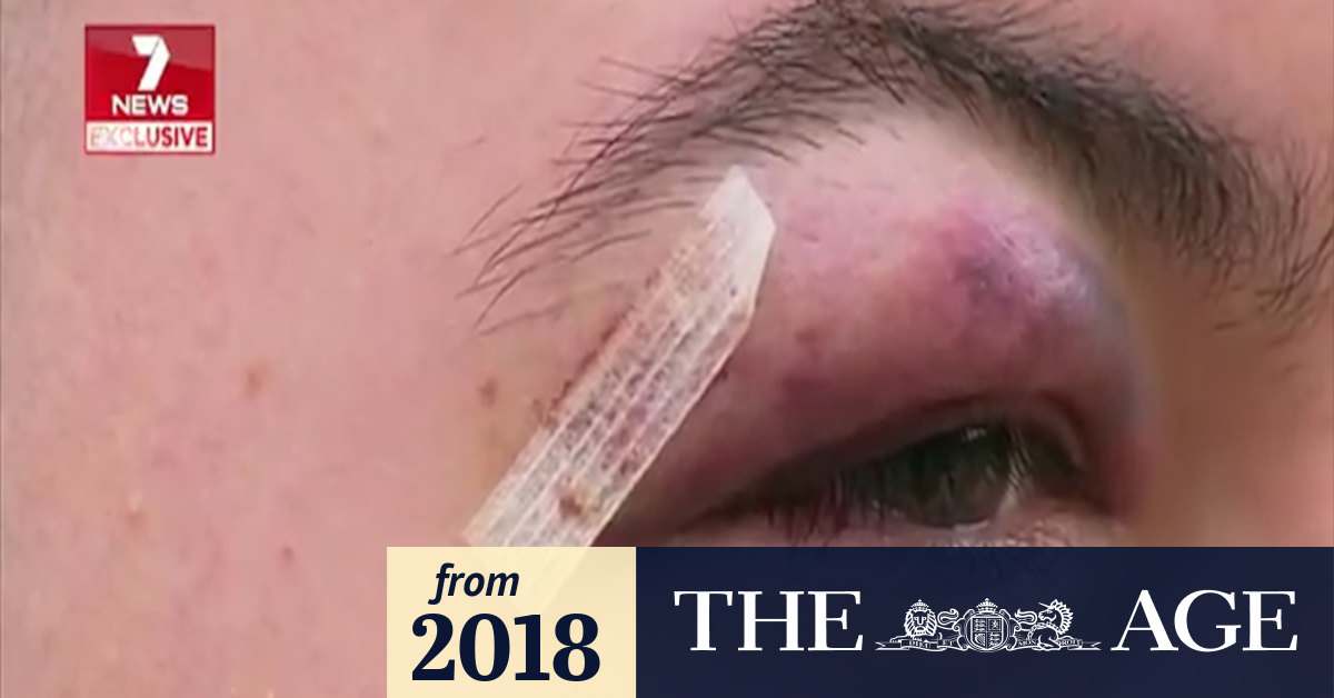 Chelsea beach violence: 19-year-old glassing victim says he could have died