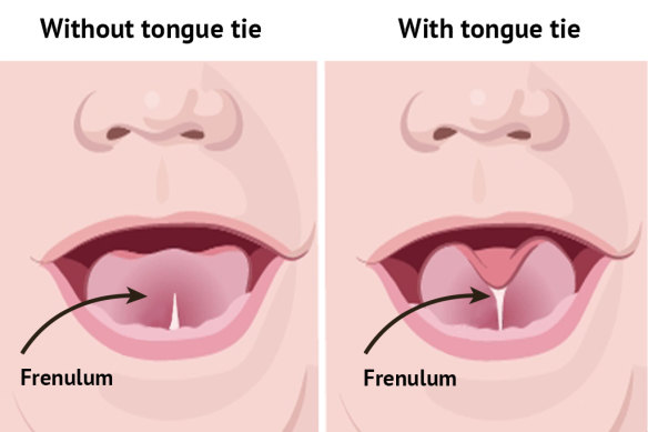 Baby tongue-tie release: Does it improve breastfeeding?