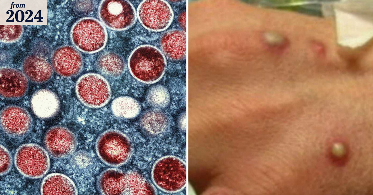 Mpox outbreak: Why have WHO declared a global emergency?