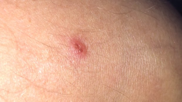 What Does A White Tail Spider Bite First Look Like