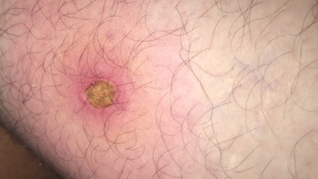 white spider bite mark