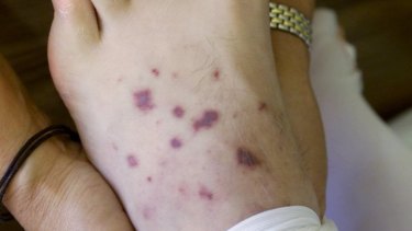Two new cases of meningococcal disease in WA